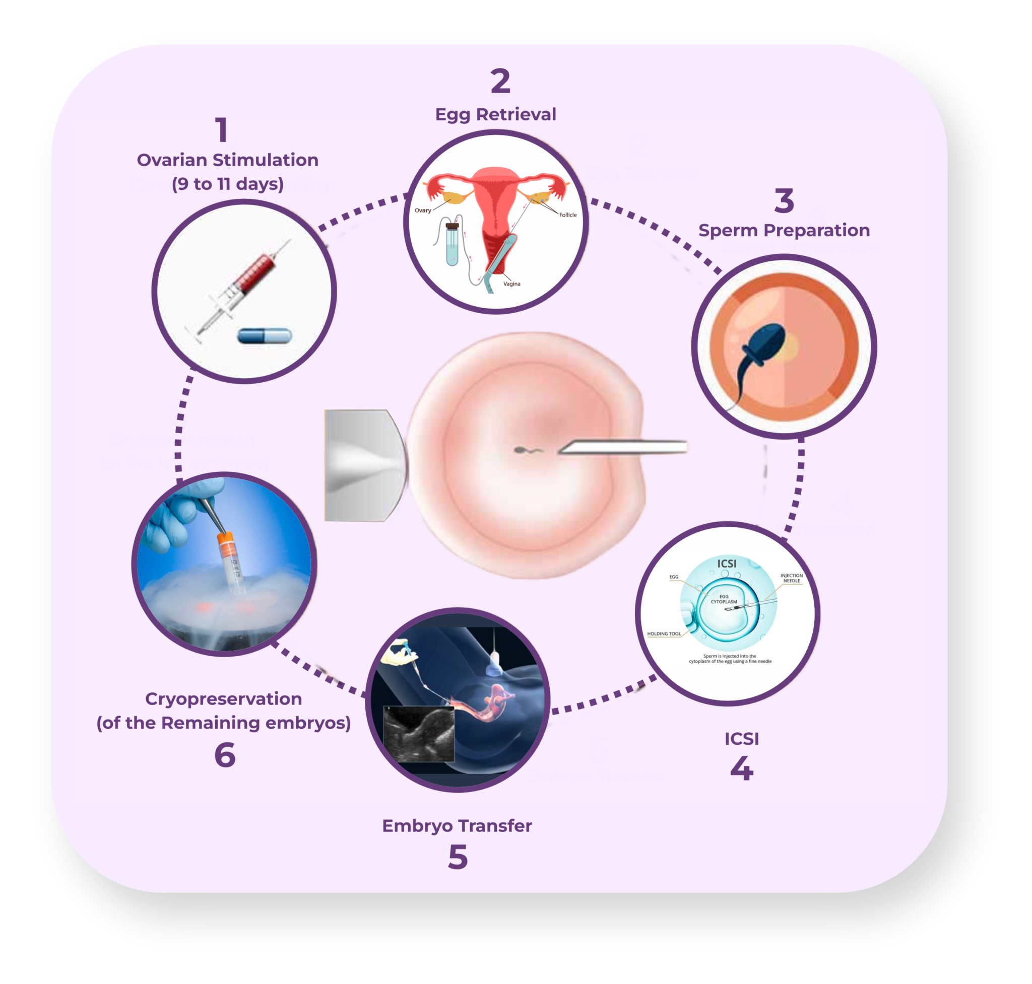ICSI in Bangalore - Aansh Ivf Hospital